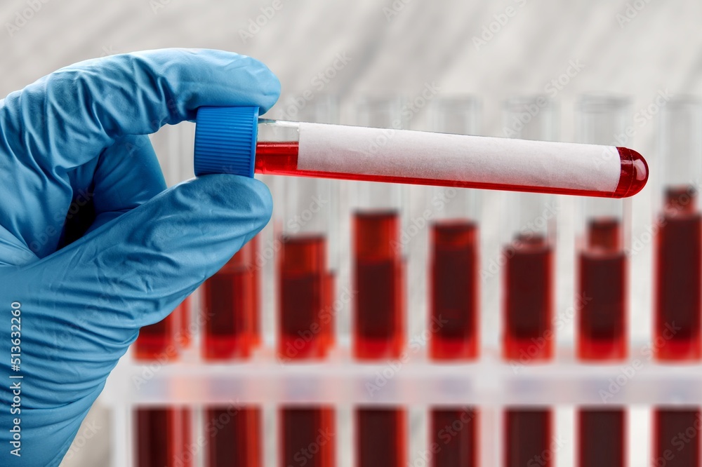 Blood sample tube for virus test. It is also known as the Moneypox ...