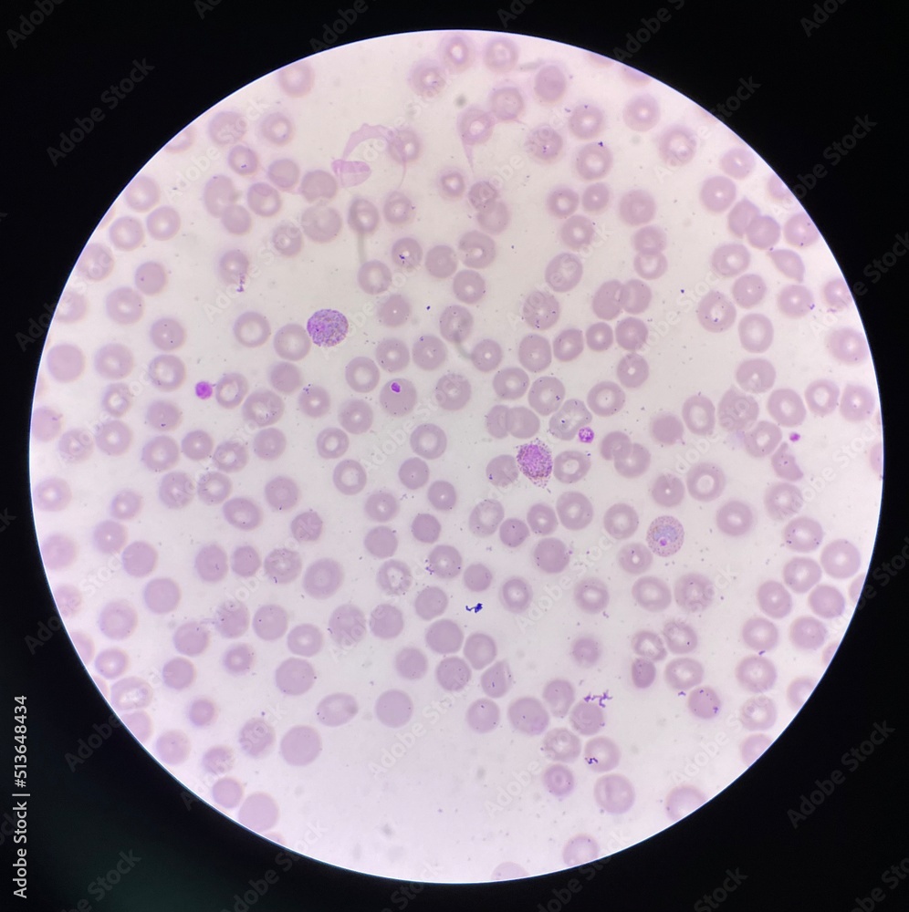 Malaria blood parasite infected red blood cells. Stock Photo | Adobe Stock