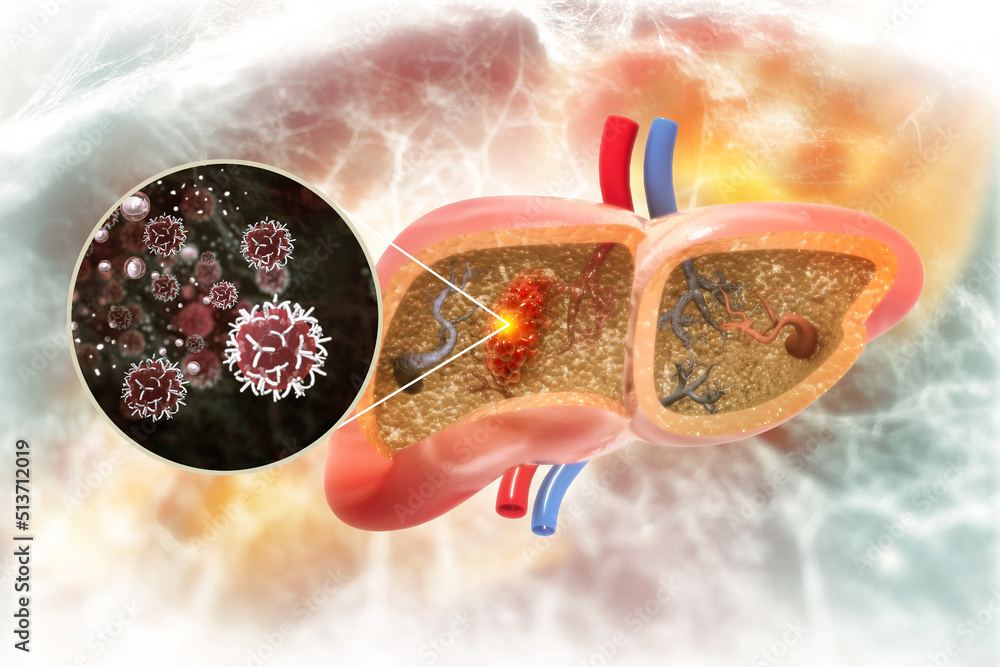 Liver cancer or liver tumor, Hepatocellular carcinoma (HCC), causes ...