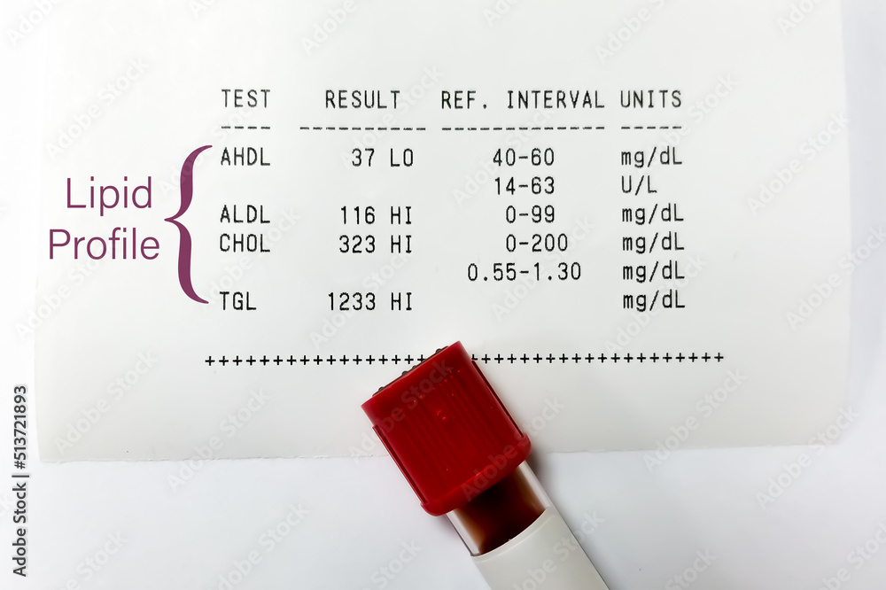 Blood sample isolated for Lipid Profile test with abnormal report ...