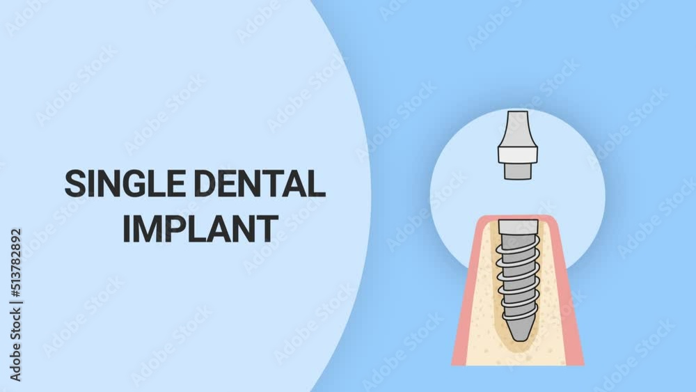 Dental Implant Procedure Explained Step by Step Stock Video | Adobe Stock