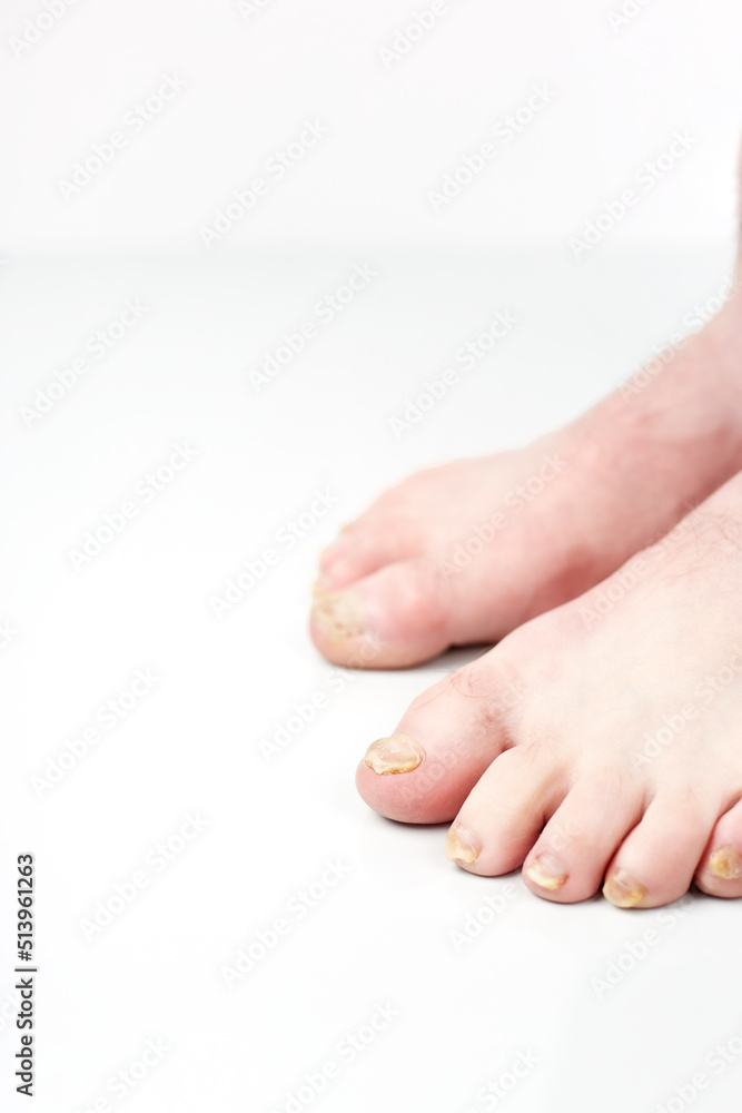 Nail fungus on legs disease. Fungal infection on nails legs, finger ...