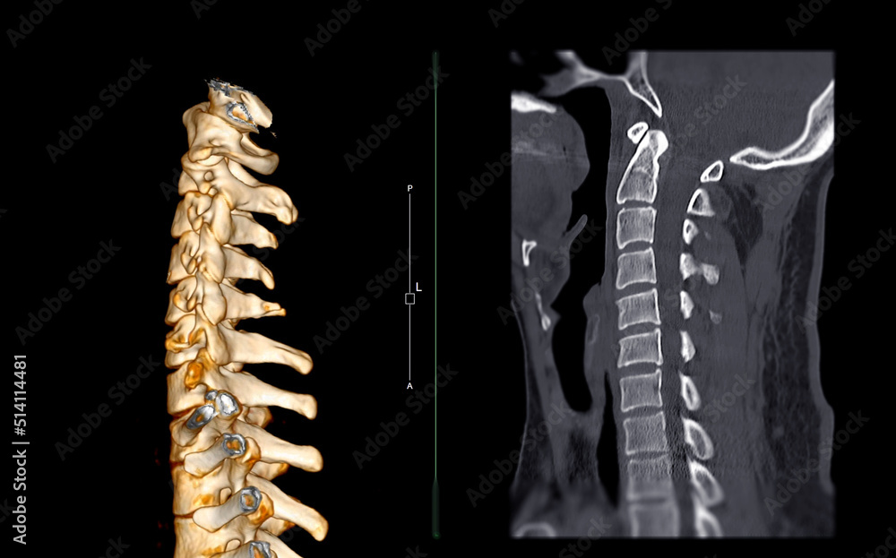 CT SCAN of Cervical Spine ( C-spine ). Stock Illustration | Adobe Stock