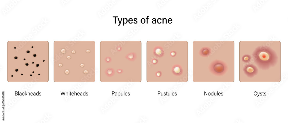 Stockvector Types Of Acne Skin Problems Blackheads Whiteheads