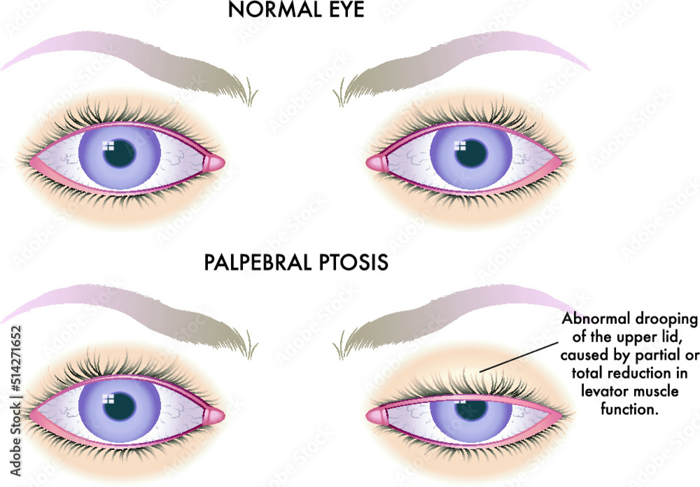 Medical illustration shows the comparison between a normal eye and one ...