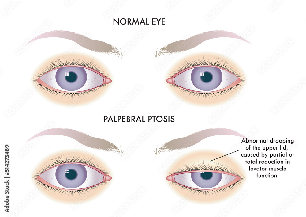 Medical illustration shows the comparison between a normal eye and one ...