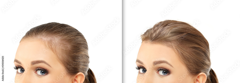 Thinning hair and hair loss,female pattern baldness,Hair transplant ...