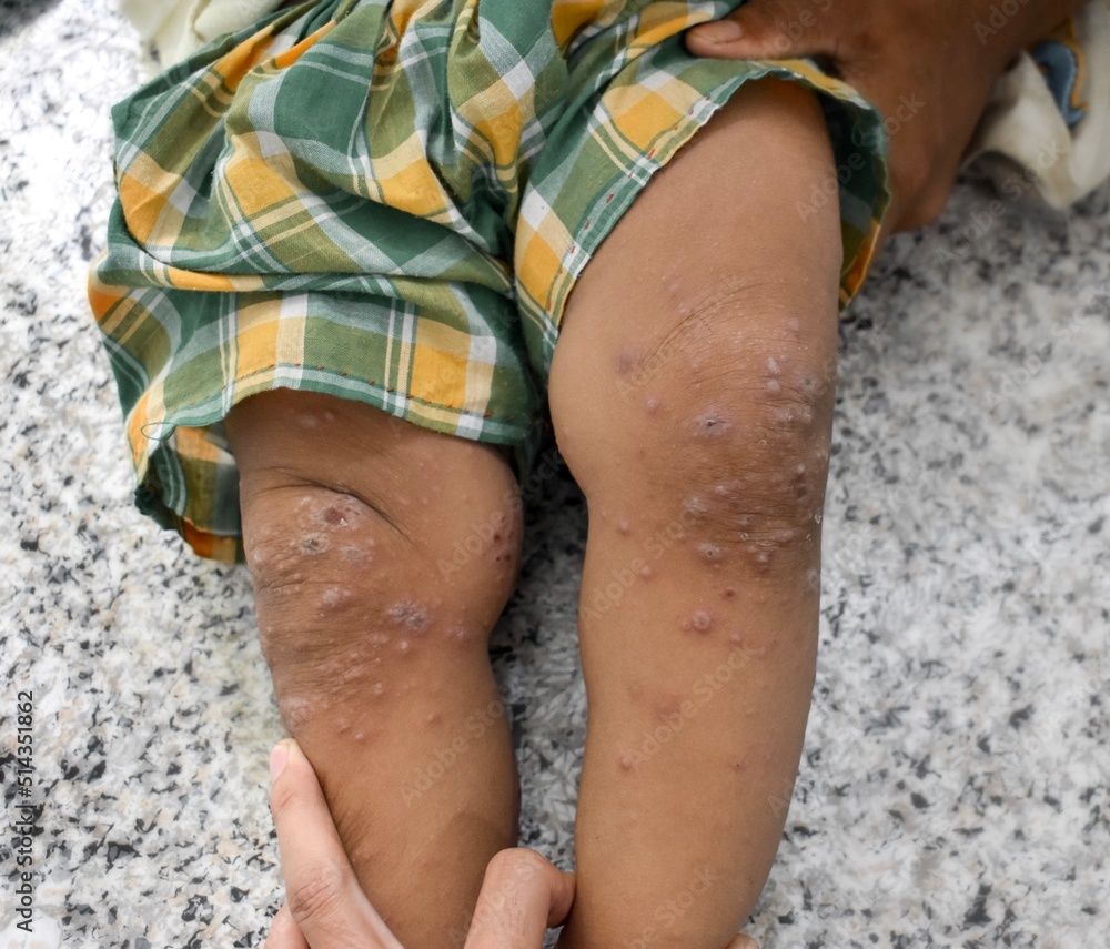 Scabies Infestation with secondary or superimposed bacterial infection ...