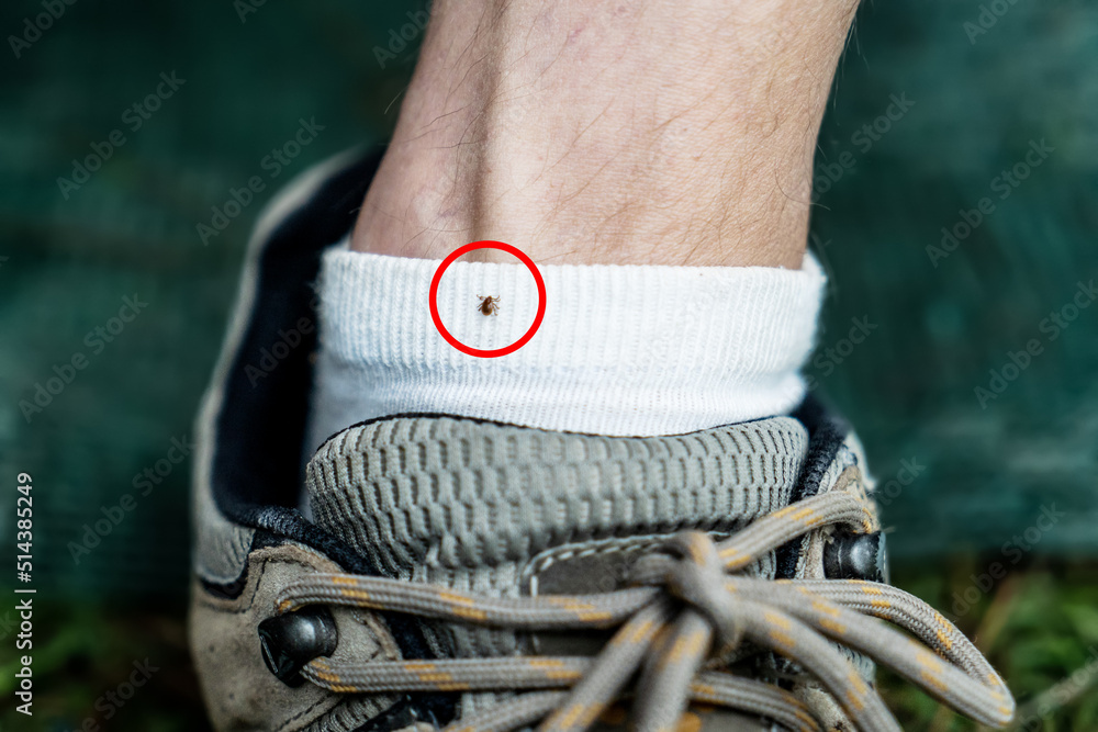 Australian bush tick sitting on a sog on a human leg. Cattle tick ...