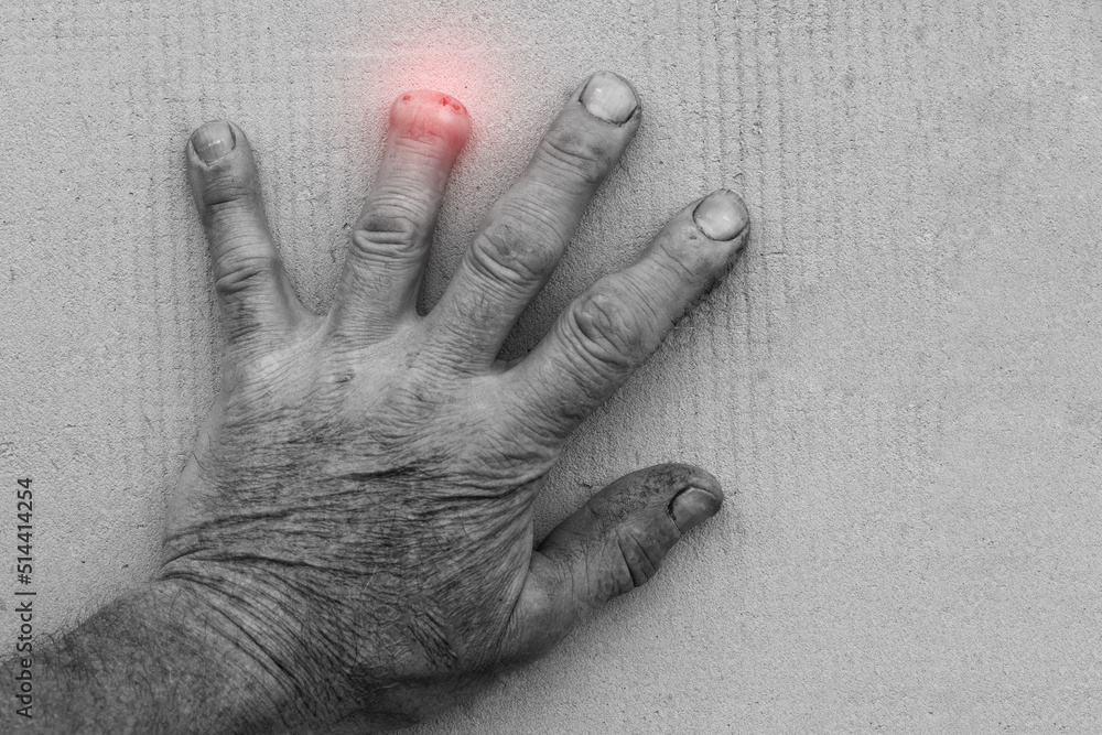 Male turner with professional injury - amputation of part of the finger ...