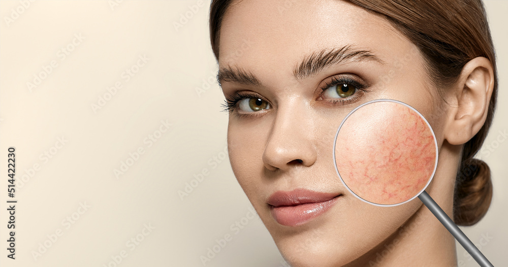 Magnifying glass showing couperose on face skin. Woman showing problems ...