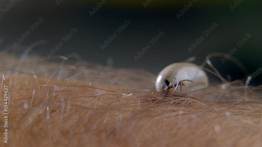 A tick infected with encephalitis or lyme disease is preparing to sting ...