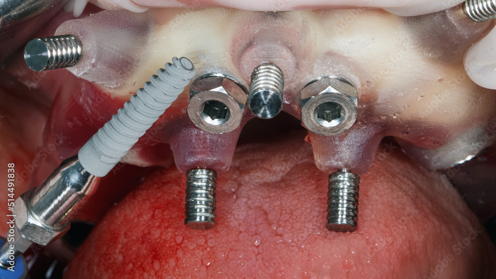 installation of a dental implant through a surgical template of the ...