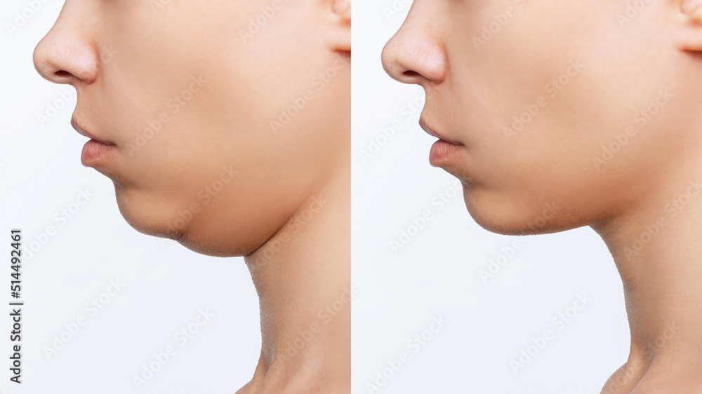 Liposuction of the double chin. Cropped shot of woman's face with chin ...