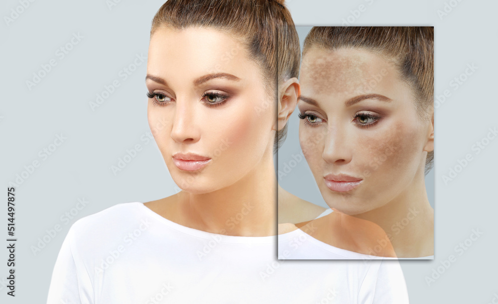 Hyperpigmentation: chloasma, melasma , age spots,Post-inflammatory ...