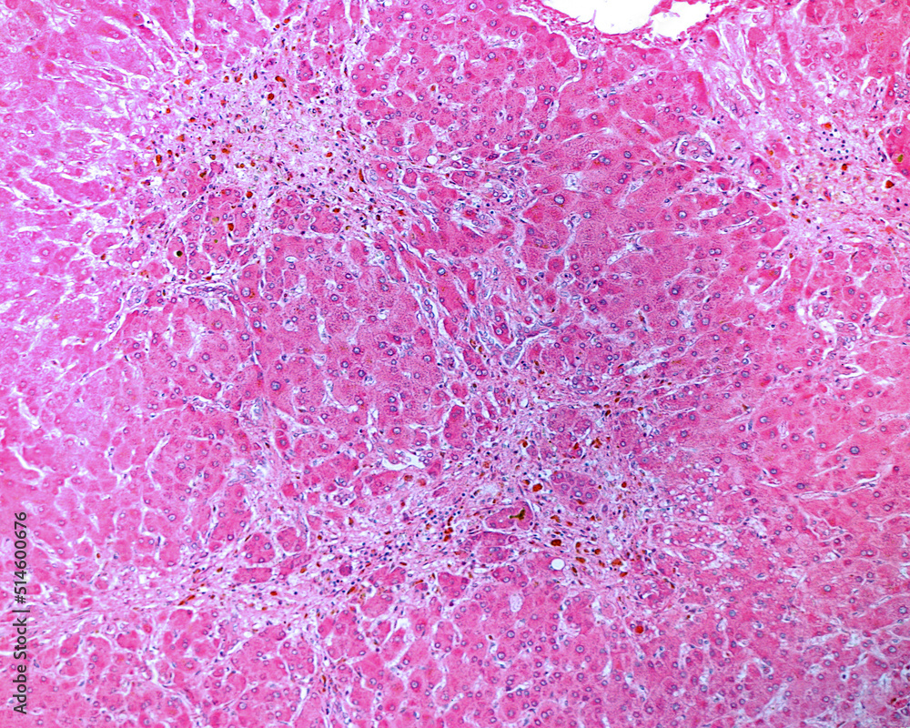 Toxic liver disease. Carbon tetrachloride Stock Photo | Adobe Stock
