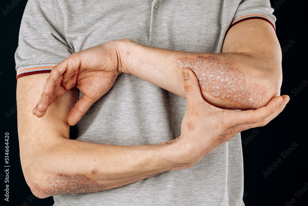 Acute psoriasis on the elbows is an autoimmune incurable dermatological ...