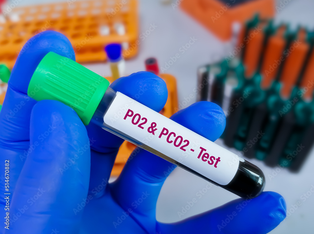 Blood sample for PCO2 (partial pressure of carbon dioxide), PO2 (partial pressure of oxygen ...