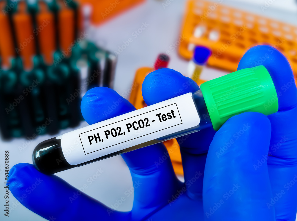 Blood sample for PH, PCO2 (partial pressure of carbon dioxide), PO2 (partial pressure of oxygen ...