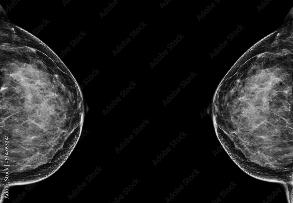 X-ray Digital Mammogram or mammography of the breast CC view. Stock ...