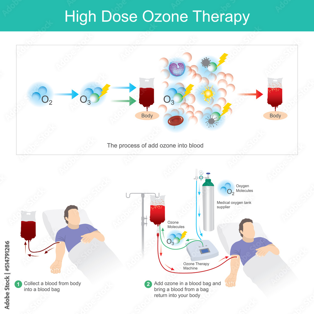 High Dose Ozone Therapy. This process add ozone in a blood bag and ...