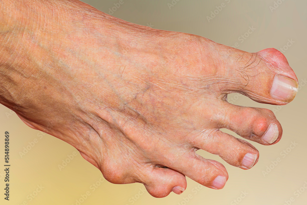Severe gout in men suffering from joint pain, bone pain, gout ...