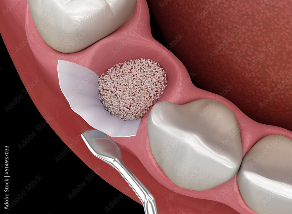 Augmentation Surgery - Adding bone after tooth extraction. 3D ...