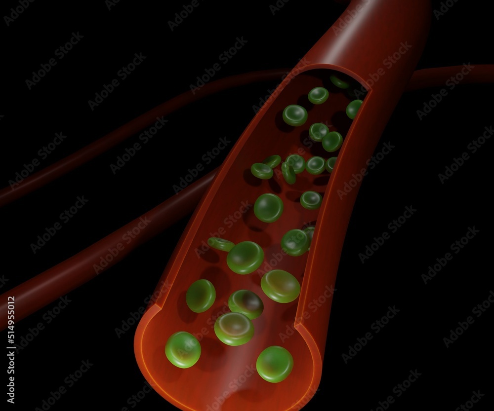 Sulfhemoglobinemia. The pigment is a greenish derivative of hemoglobin ...