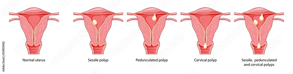 Set Of Polyps In The Uterus Female Reproductive System In Cross Sections Diseases And Normal