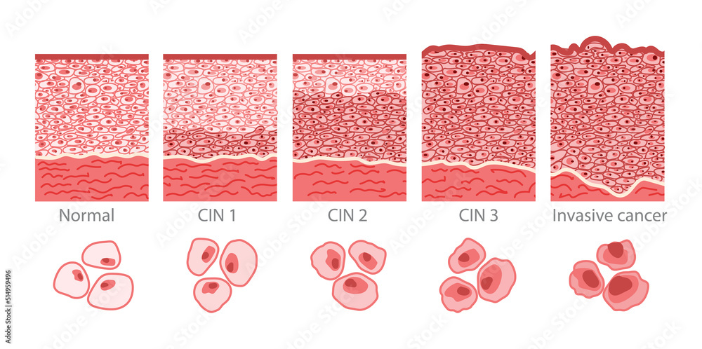Cervical cancer cells elongated Dysplasia stages infographic Female ...