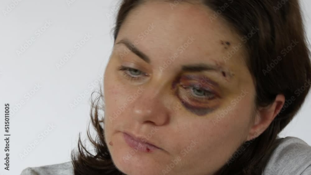 Large real bruise hematoma under the eye of a young woman, purple ...