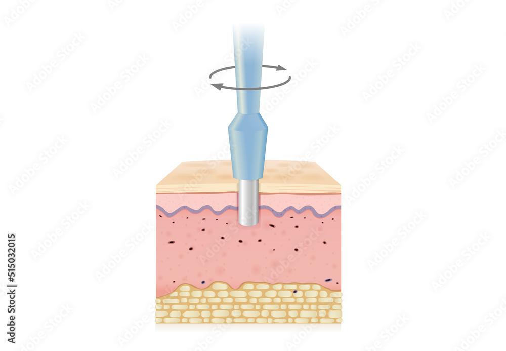 Turn the medical instrument and cut down to the skin layer to get ...