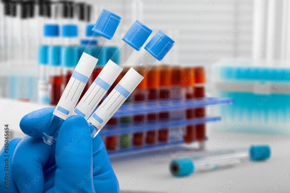 Blood sample of patient for complete screening test in laboratory ...