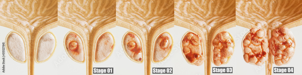 Prostate cancer all 4 stages - detailed close-up - 3D rendering Stock ...