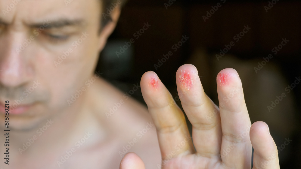 Sad unhappy man suffering pain because of injured fingers on his hand ...
