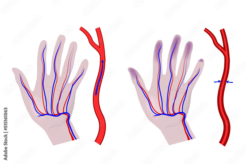 vibration syndrome. Hand with a diagram of constricted blood vessels ...