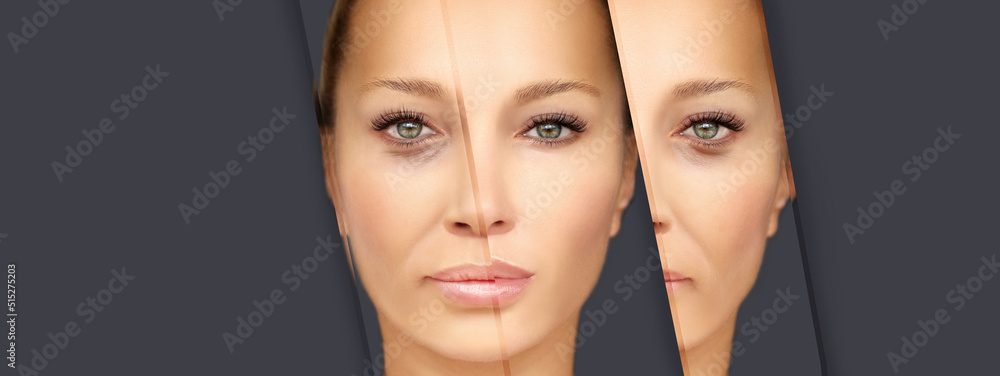Effects of ageing,Frownscowl lines ,Nasolabial folds,Neck ,Under eye ...