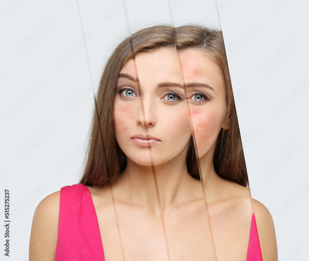 Acne,Skin concern,blemish-prone skin and acne, Rosacea,different types ...