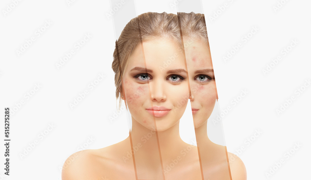 Acne,Skin concern,blemish-prone skin and acne, Rosacea,different types ...