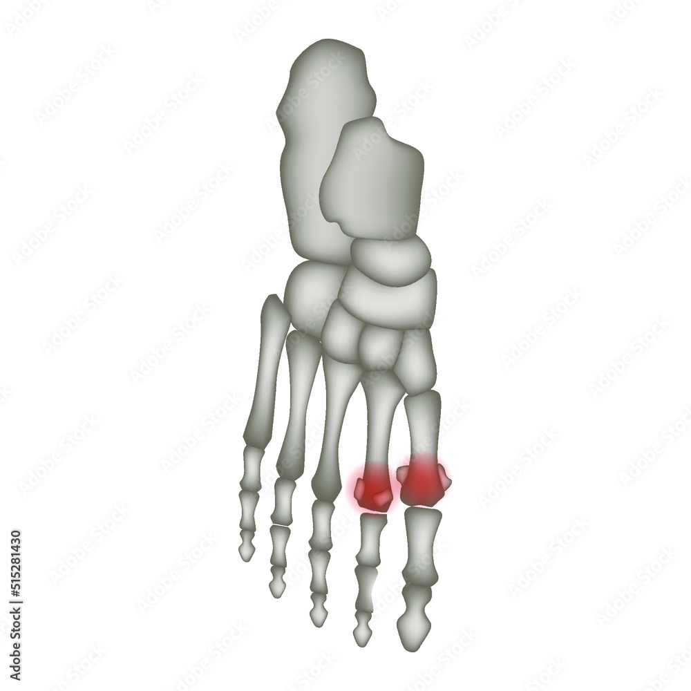 Freiberg disease. Aseptic necrosis of the metatarsal heads. Foot ...