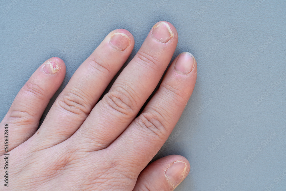 Close-up of hand finger with a fungus on a gray background. Onycholysis ...
