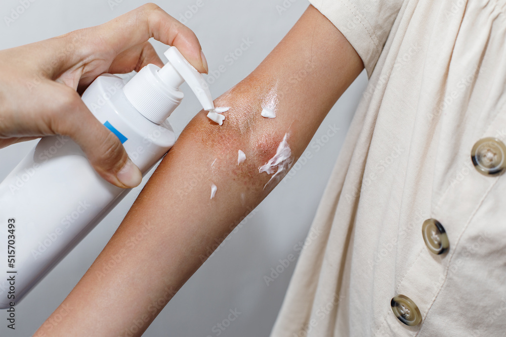 Emollient cream smeared on atopic dermatitis in a child in the elbow ...