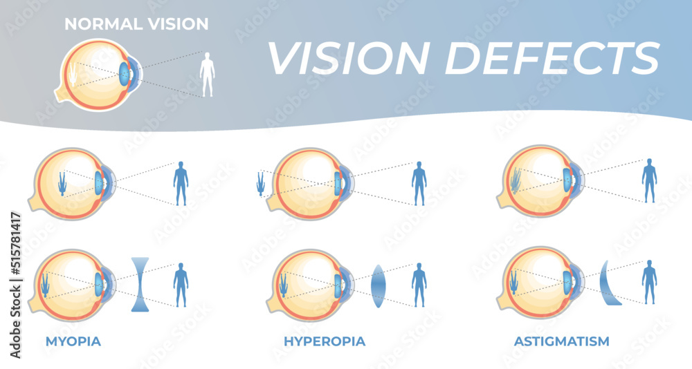 Vision defects and their correction with intraocular lenses. Vision ...