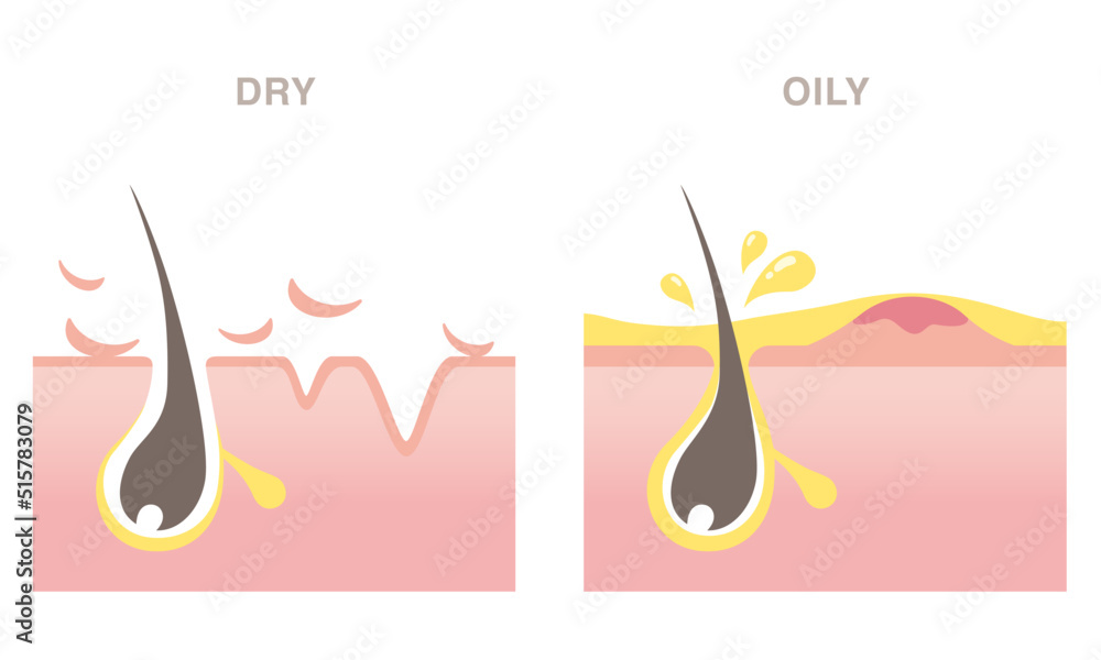 Skin cross section of pore types. Acne on oily skin, wrinkles on dry ...