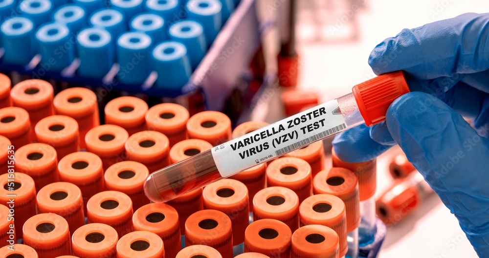 Varicella Zoster Virus (VZV) Test tube with blood sample in infection ...