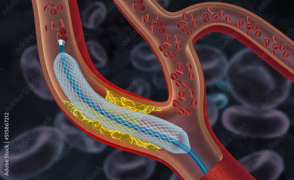 Stent and catheter for implantation into blood vessel, stent ...