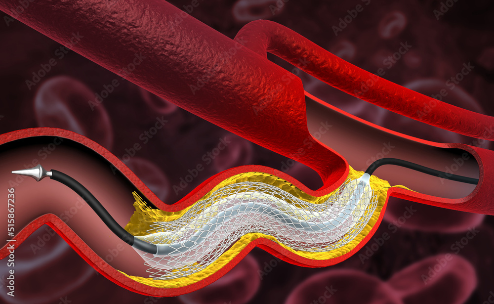 Stent and catheter for implantation into blood vessel, stent ...