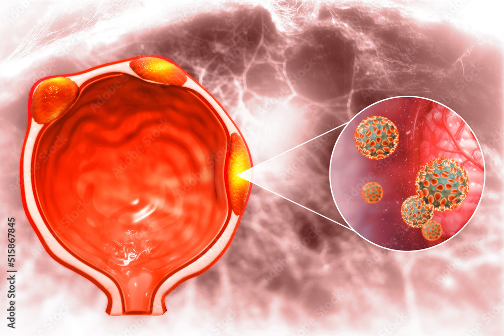 prostate cancer, prostatic hyperplasia, Structure of male prostate ...
