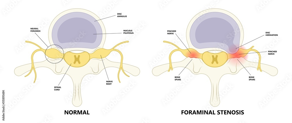 Vecteur Stock anti inflammatory drugs spine back hip pain lumbar Bone ...