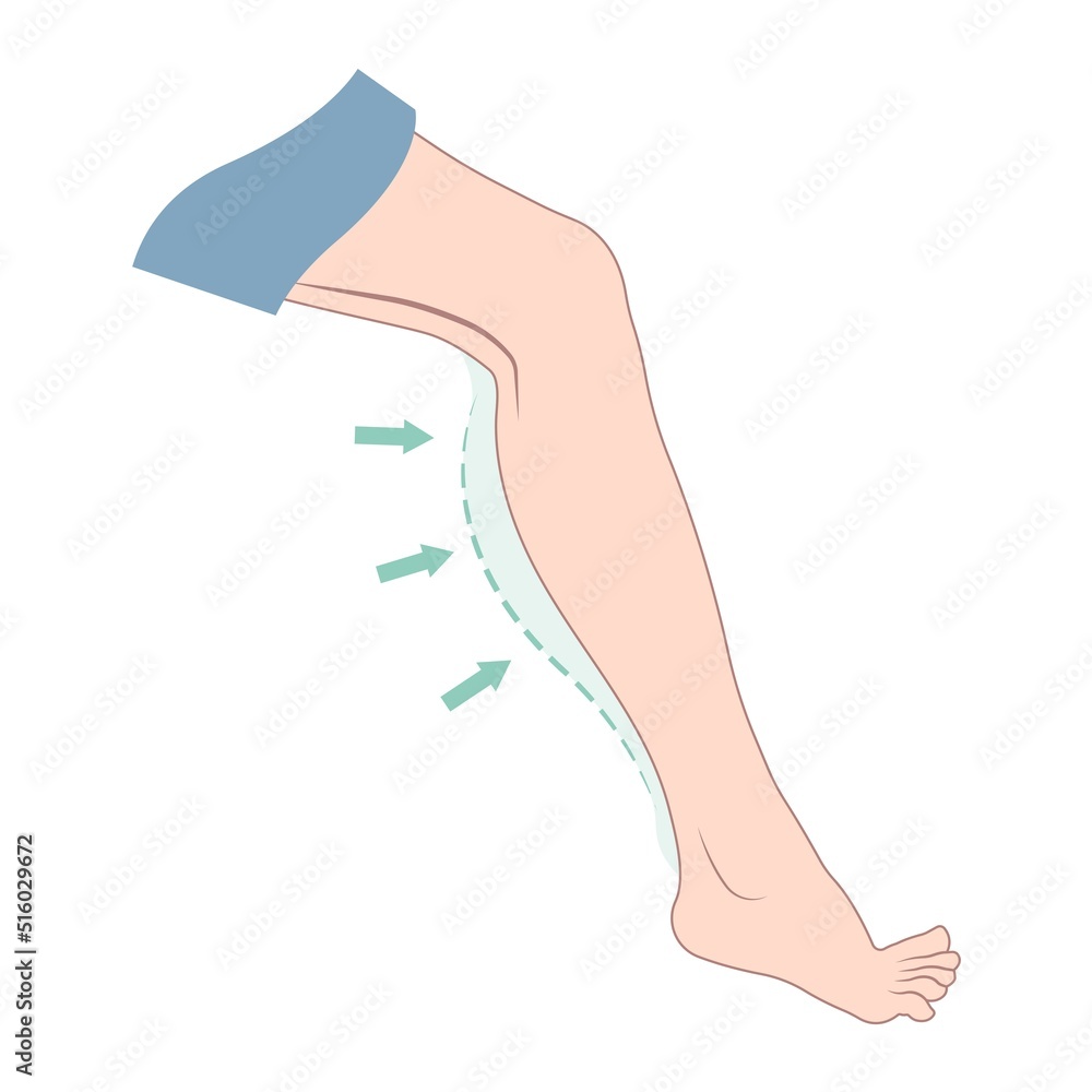 Vetor do Stock: women calf reduce slim leg size deformity lose fat Gel ...